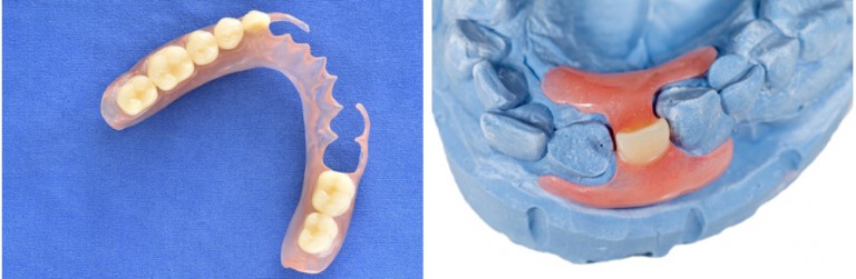 Tannimplantat - Tannestetisk Senter